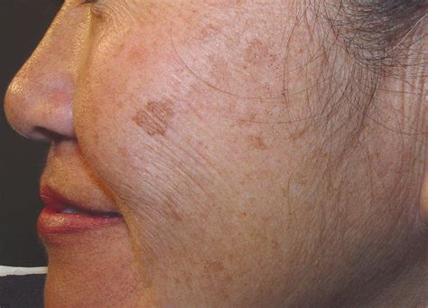 Hyperpigmentation Causes Risk Factors Treatment Options