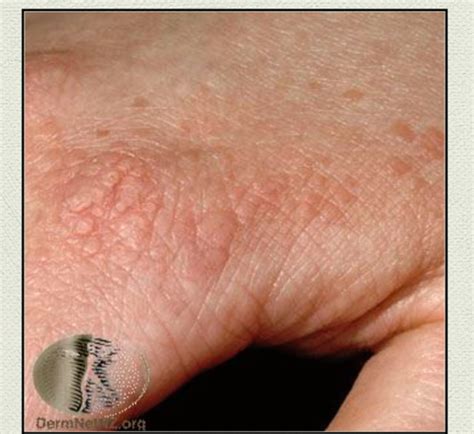Viral Skin Infections Flashcards Quizlet