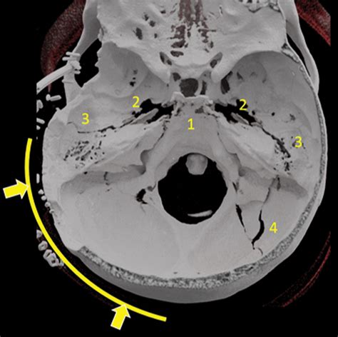 Ct Of Skull Base Fractures Classification Systems Complications And Management Radiographics