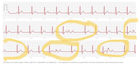 Ive Been Feeling A Flutter In My Chest More Than Normal Caught It