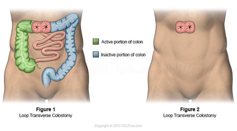 Ostoma Tology Colostomy Ileostomy Urostomy Nursing CEU CEUfast
