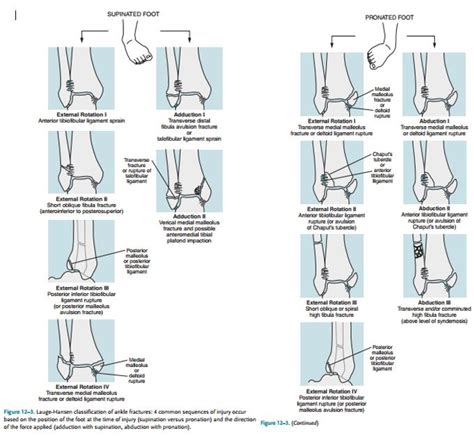 Lauge Hansen Classification System For Ankle Fractures Dr Steven Edwards Facps Fellowship