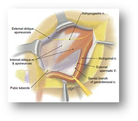 Inguinal Hernia Sexual Dysfunction Idgfn
