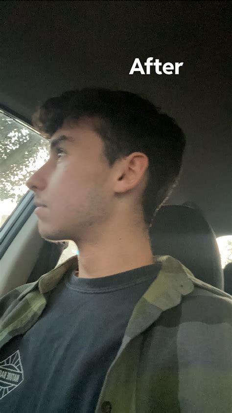 Before And After 7 Weeks Post Op R Jawsurgery