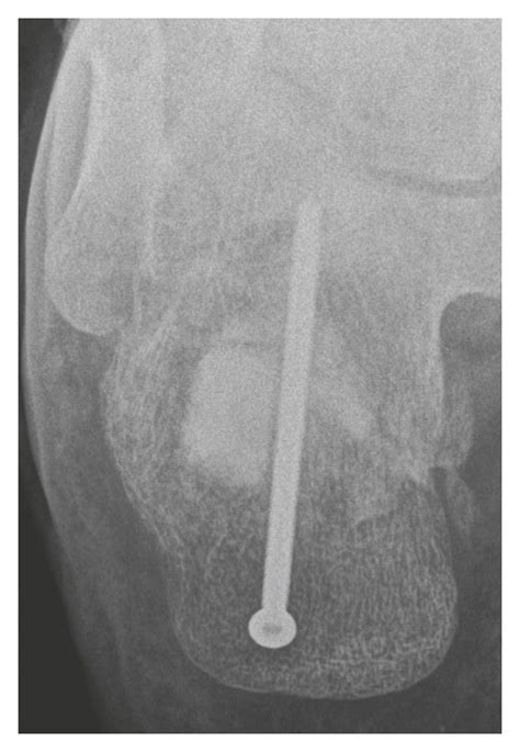 Imaging After 2 Months Revealed A Partial Lack Of Fracture Reduction