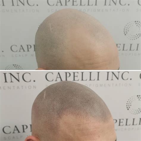 What Is Scalp Micropigmentation Scalp Micropigmentation Liverpool Smp