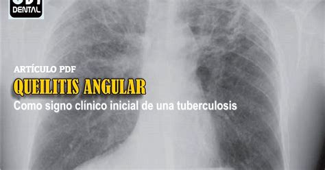 Pdf Queilitis Angular Como Signo Clínico Inicial De Una Tuberculosis