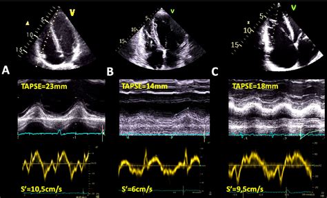 Figure 1 From The Dysfunctional Right Ventricle In Dilated Cardiomyopathies Looking From The