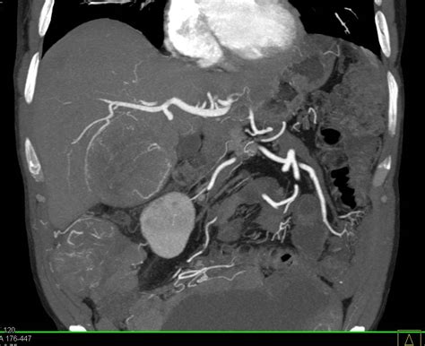 Small Bowel Gist Tumor With Cystic Metastases Small Bowel Radiology