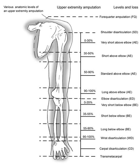 Principles Of Amputation Physiopedia