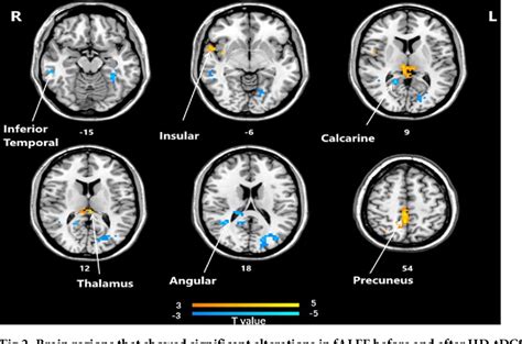 Figure 2 From Repeated Anodal High Definition Transcranial Direct Current Stimulation Over The