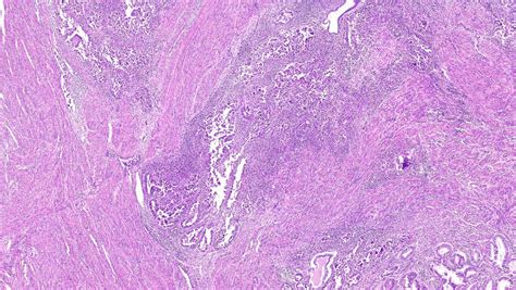 Pathology Outlines Pole Ultramutated Endometrial Carcinoma