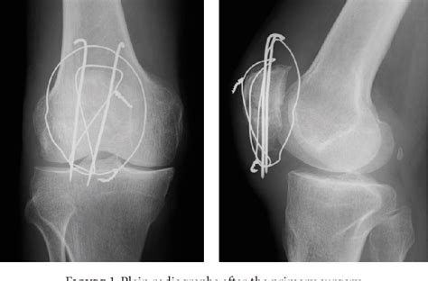 Figure 1 From Arthroscopic Removal Of A Wire Fragment From The Posterior Septum Of The Knee