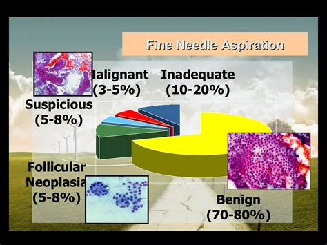 Solitary Thyroid Nodule Ppt