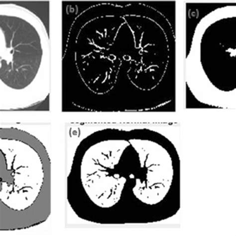 K Means Segmentation Of Non Covid Ct Image A Original Non Covid Ct