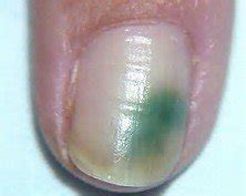 How To Deal With A Greenie Nail Rebecca Orme Nail Pro