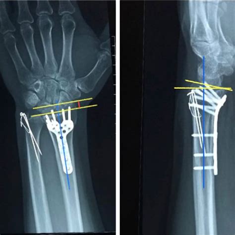 Radial Height And Volar Tilt Measured In A Case Fixed With A