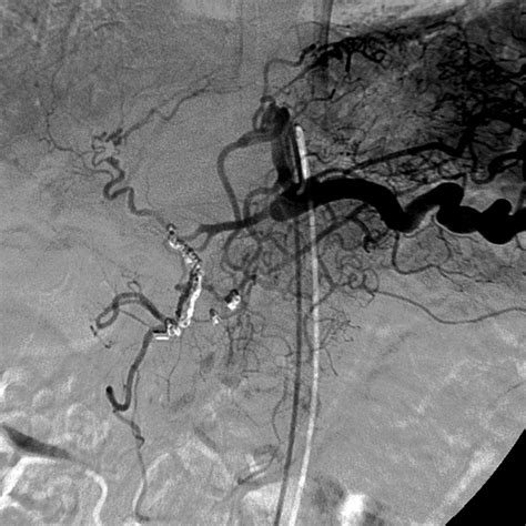 Side Branch Embolization Before 90y Radioembolization Rate Of Recanalization And New Collateral