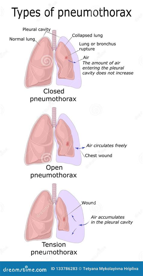 Pneumothorax Types Stock Illustrations 2 Pneumothorax Types Stock Illustrations Vectors