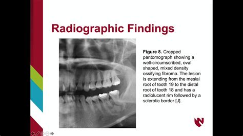 Ossifying Fibroma
