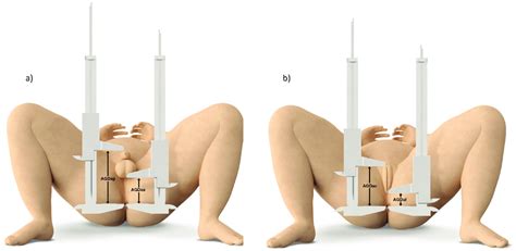 Illustration Of AGD Measurements In Babes A And Girls B Using The Download Scientific