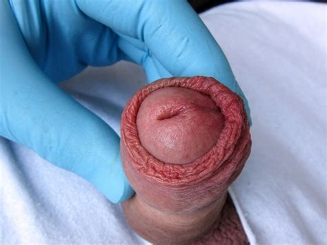 Balanitis Patofisiologi Diagnosis Penatalaksanaan Alomedika