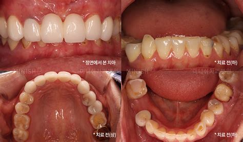 칼럼 손상된 치아 치료 방법은