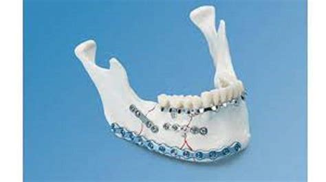 Mandible Plating System Market Recent Trends And Growth 2023 2030 Osteonic Depuy Synthes Acumed