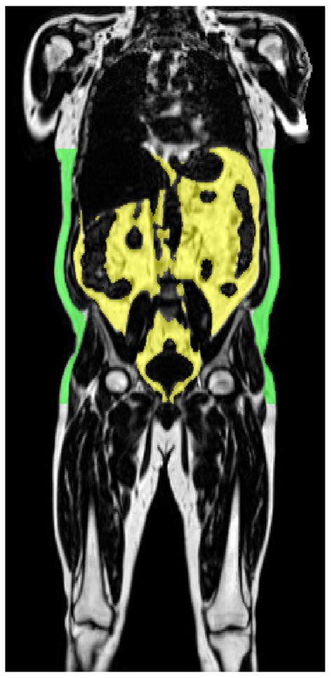 Result For Automatic Segmentation Of Abdominal Subcutaneous Adipose Download Scientific Diagram