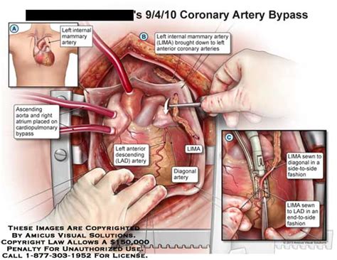 Amicus Illustration Of Amicus Surgery Heart Artery Internal Mammary