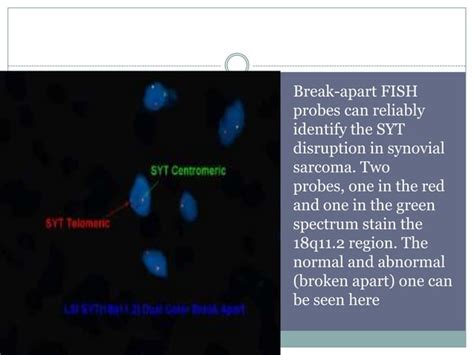 Synovial Cell Sarcoma Dr Narmada Pptx Bone And Joint Conditions Diseases And Conditions