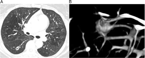 Figure 1 From The Utility Of Nodule Volume In The Context Of Malignancy Prediction For Small