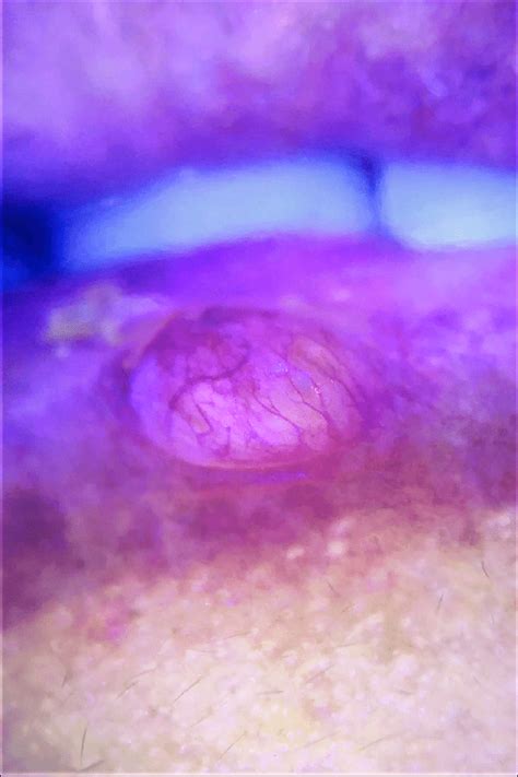 Focal Dermoscopy Showing A Reticular Arrangement Of Vessels Overlying Download Scientific