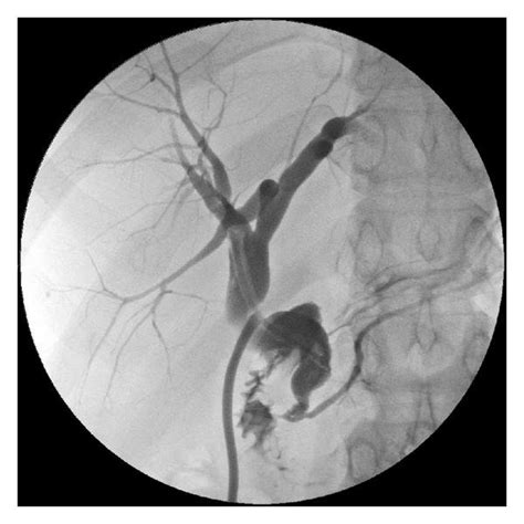Postoperative T Tube Cholangiogram Illustrating Normal Duodenal Filling