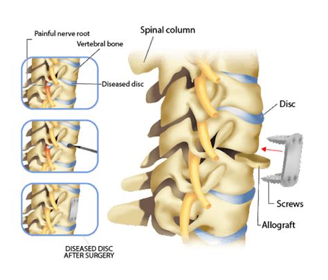 Anterior Cervical Discectomy And Fusion What To Know