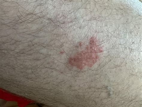Spreading Rash Rmedical