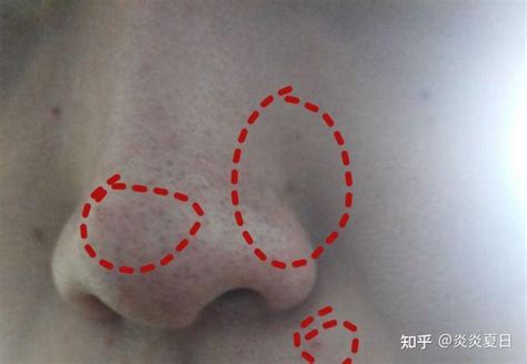 酒糟鼻到底能不能治好啊 知乎