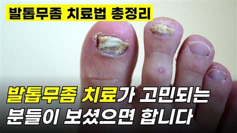 발톱무좀이 있는 분들에게 ㅣ 발톱무좀 치료법 전부 정리했습니다 Youtube