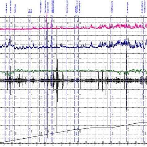 Cystometrogram Cmg With Bladder Outlet Obstruction Boo And Detrusor