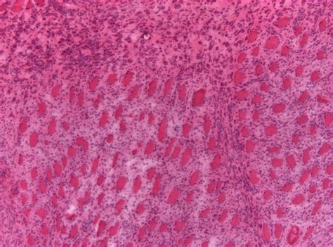 Proliferative Myositis