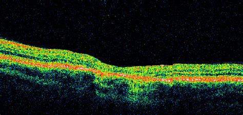 C Optical Coherence Tomography Shallowed Foveolar Depression Download Scientific Diagram