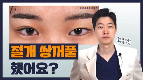 절개쌍꺼풀 후 눈재수술 부분절개로 다시 해결완료 [히트성형외과 눈재수술] Youtube