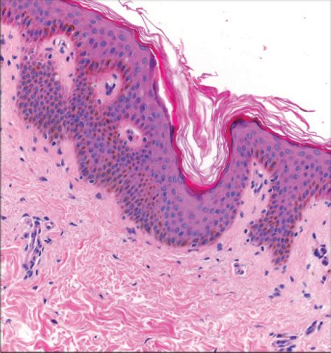 Linear And Whorled Nevoid Hypermelanosis A Case Report With
