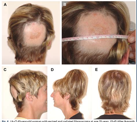 Figure 4 From Scalp Repair Using Tissue Expanders Semantic Scholar