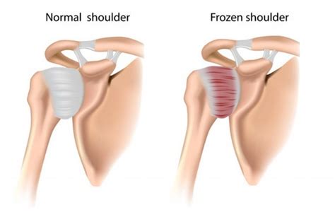 Frozen Shoulder