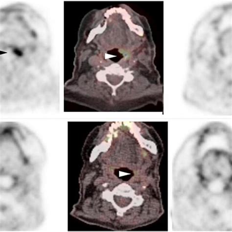 75 Year Old Man With Left Tongue Base Squamous Cell Carcinoma Baseline