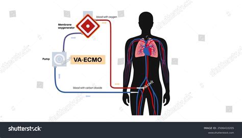 Vv Ecmo Extracorporeal Membrane Oxygenation Va Ecmo In Management Of