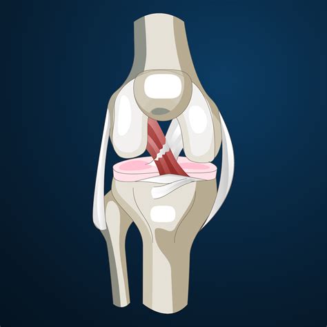 Acl Tear Surgery And Information Colorado Springs Sports Doctor