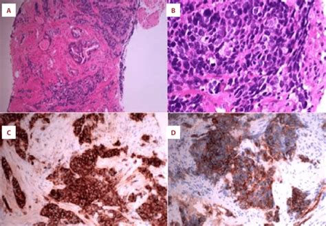 High Grade Neuroendocrine Carcinoma Of The Prostate Histopathological
