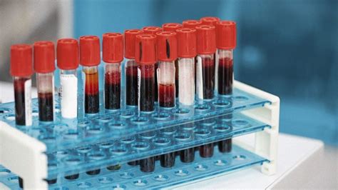 Smoldering Multiple Myeloma What It Is Symptoms And More